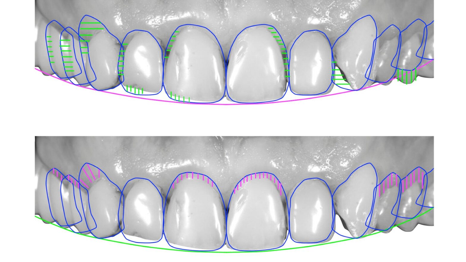 How to Achieve a Beautiful Smile with Smile Design - Expert Dental Care ...